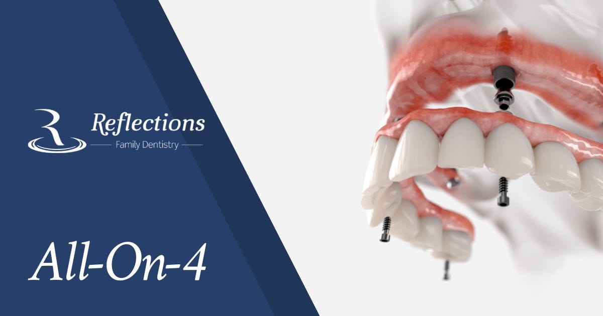 All On Four Implant Supported Denture — Reflections Family Dentistry ...