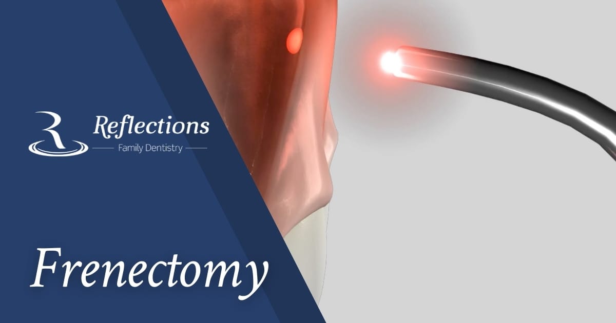 Frenectomy — Reflections Family Dentistry — Granite Bay, CA