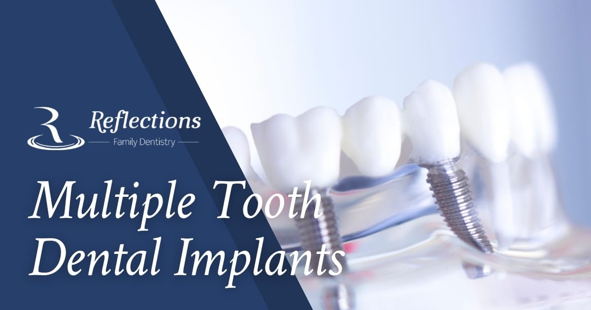 Multiple Tooth Dental Implants — Reflections Family Dentistry — Granite ...