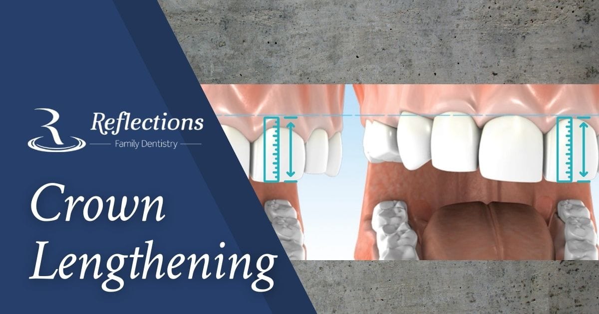 Functional Crown Lengthening — Reflections Family Dentistry — Granite ...
