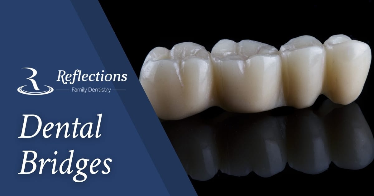 Dental Bridge — Reflections Family Dentistry — Granite Bay, CA