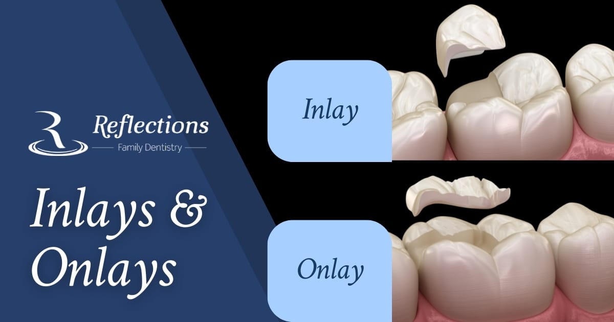 Inlay Onlay — Reflections Family Dentistry — Granite Bay, CA